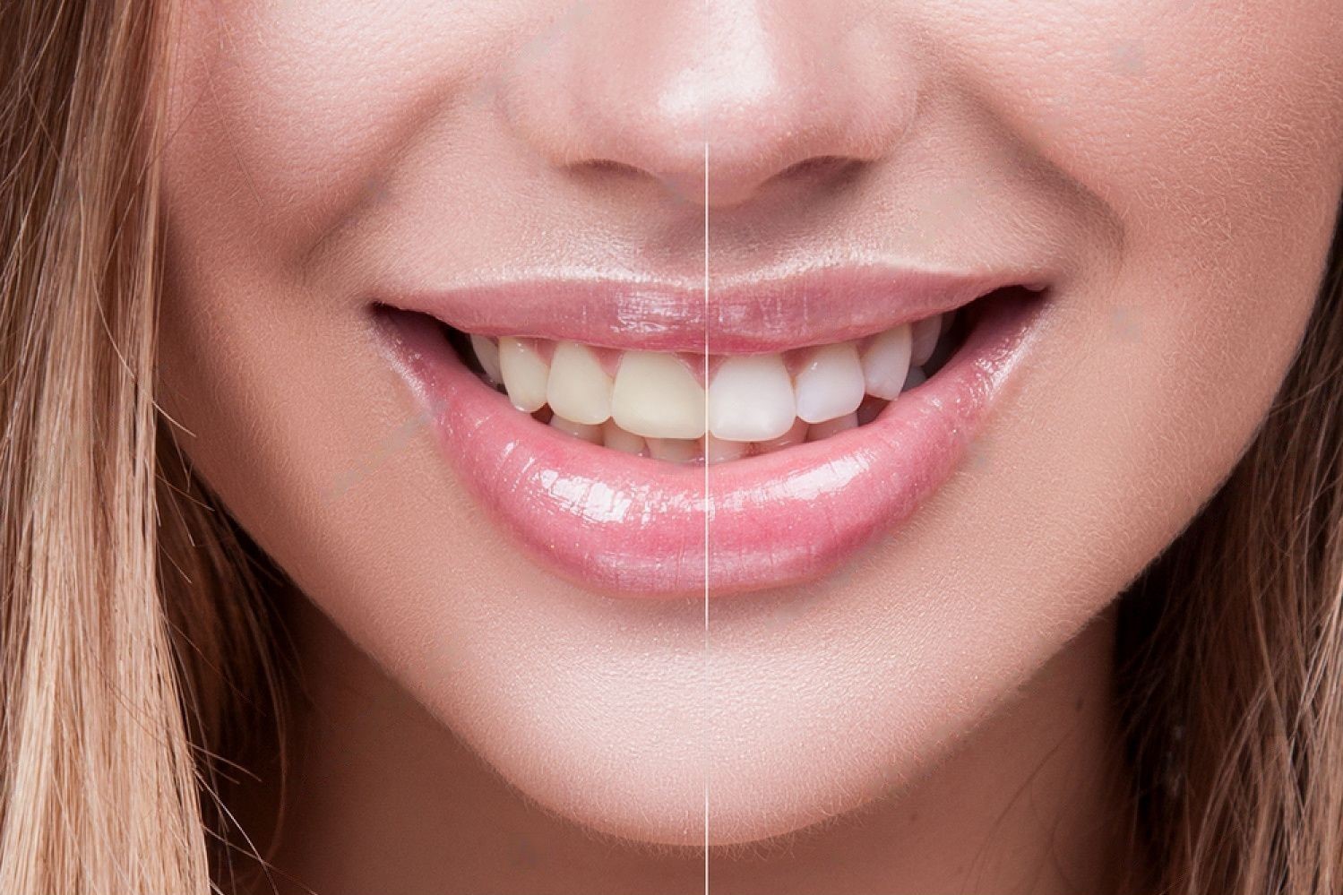 Can You Get Your Teeth Whitened If You Have Cavities Harpreet Singh Can You Get Your Teeth Whitened If You Have Cavities Harpreet Singh